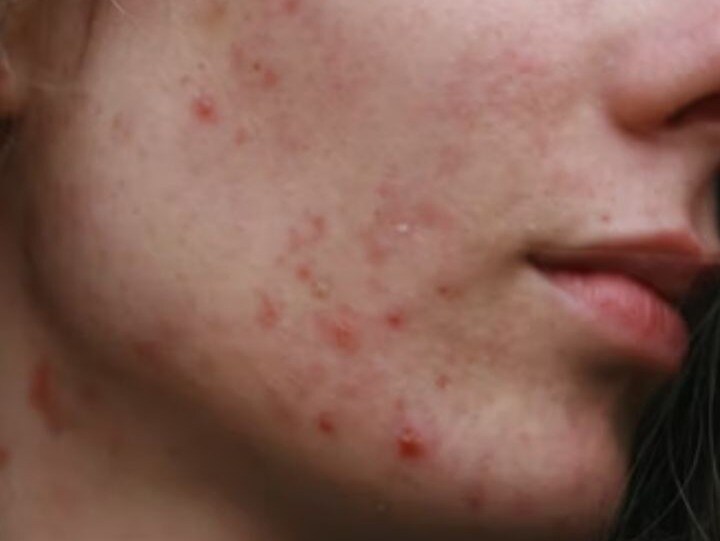 Best Foods That Fight Acne