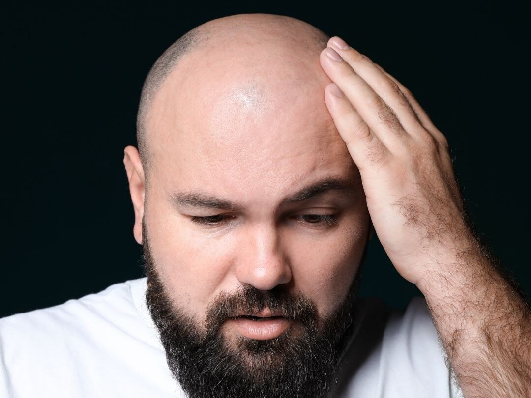 गहू खाल्ल्याने टक्कल पडलं? बुलडाण्यातील केसगळतीचे काय आहे पंजाब कनेक्शन