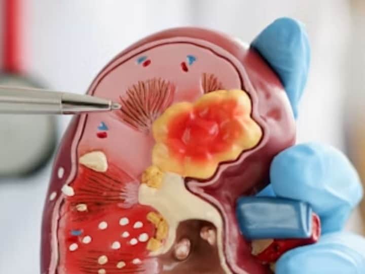 Daily Habits That Can Keep Your Kidneys Healthy