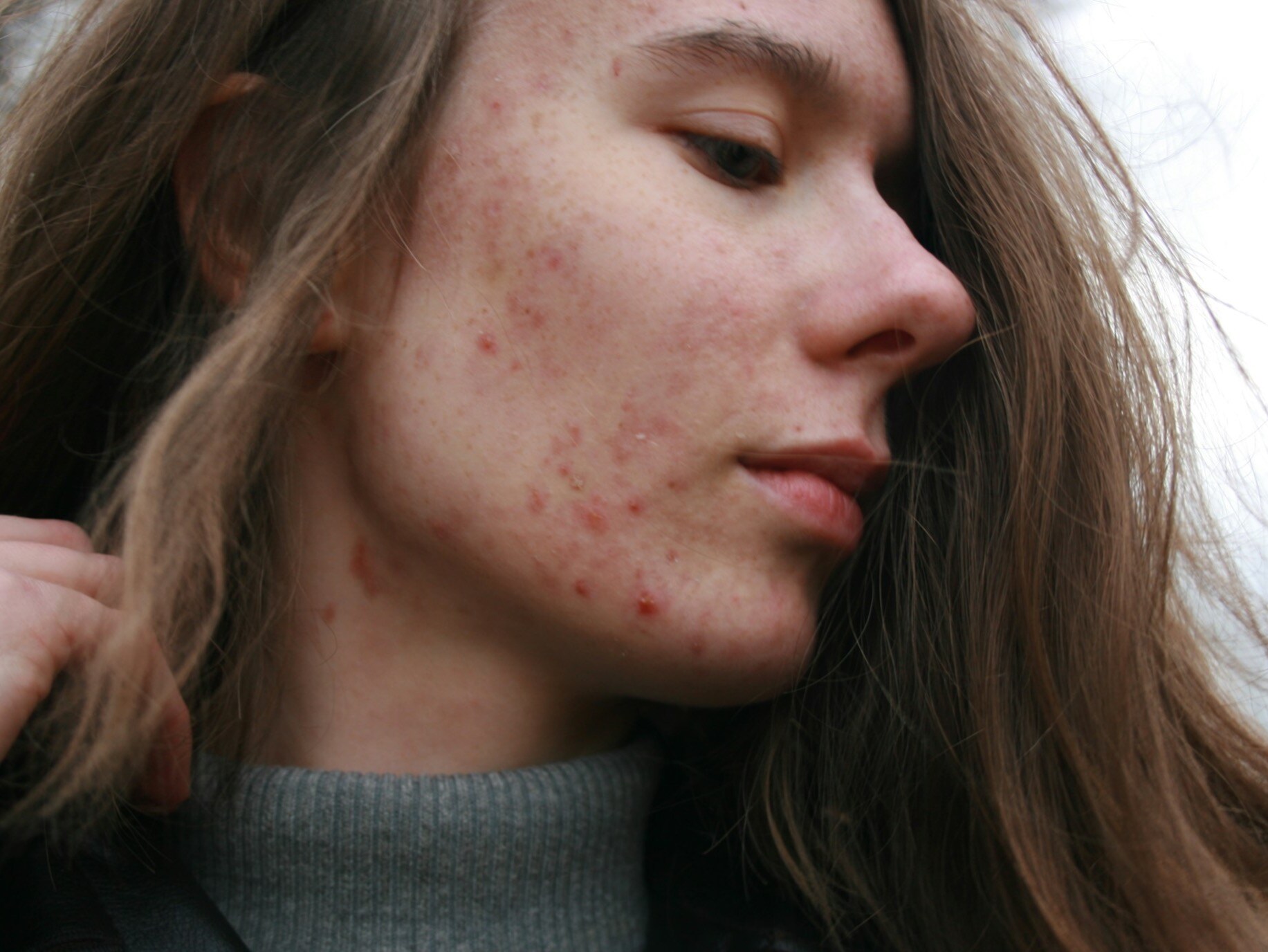 Got A Pimple? Here’s What You Can Do