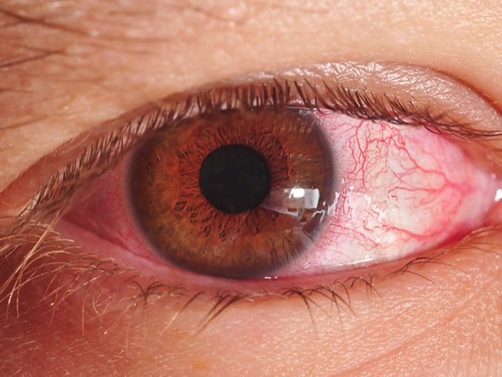 Tips To Avoid Conjunctivitis