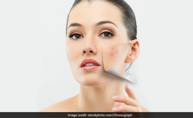Post-Workout Acne: Tips And Tricks That Can Help In Reducing Exercise ...